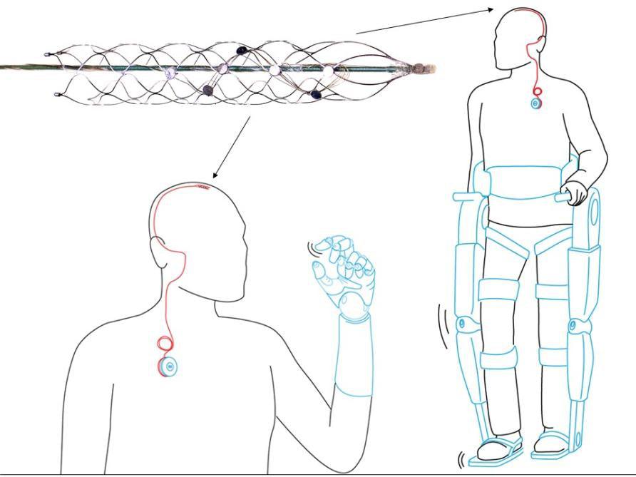 a technology that can replace open brain surgeries